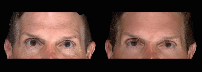 emface | BTL Aesthetics